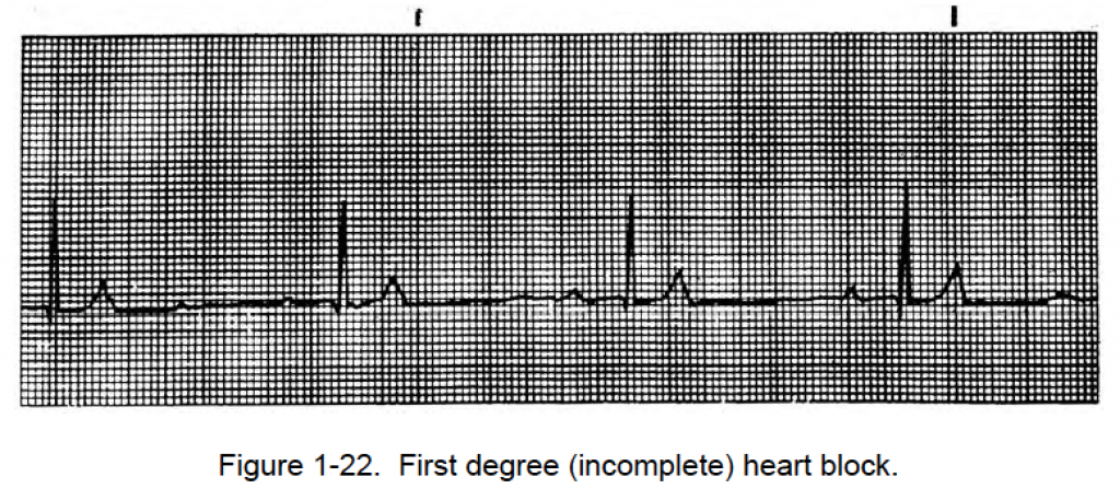 1-10. HEART BLOCKS - Cardiac Rhythm Interpretation