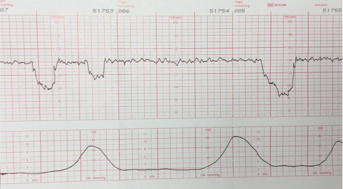 Variable Decelerations - Military Obstetrics & Gynecology - 3rd Edition