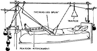1-37. SKELETAL TRACTION FOR THE FEMUR